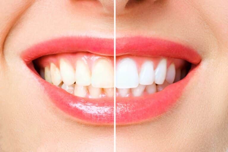 Gum disease: Straighten teeth with braces or Invisalign?